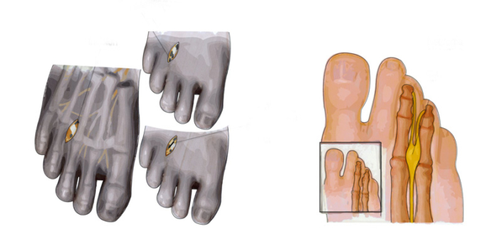 Patologie - Neuroma di Morton - Pio Maria De Pasquali